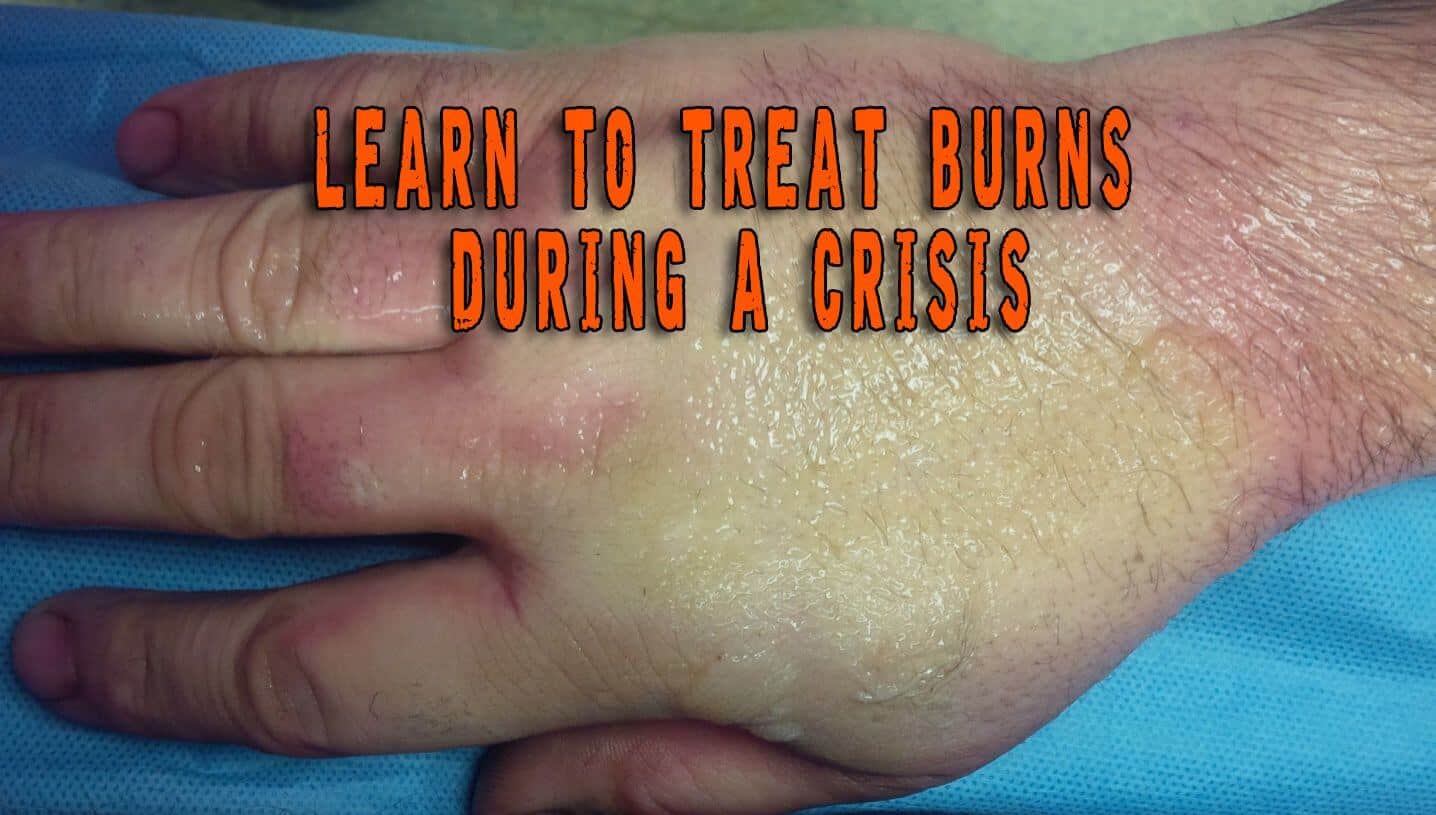 Learn To Treat Burns During A Crisis - Prepper's Will